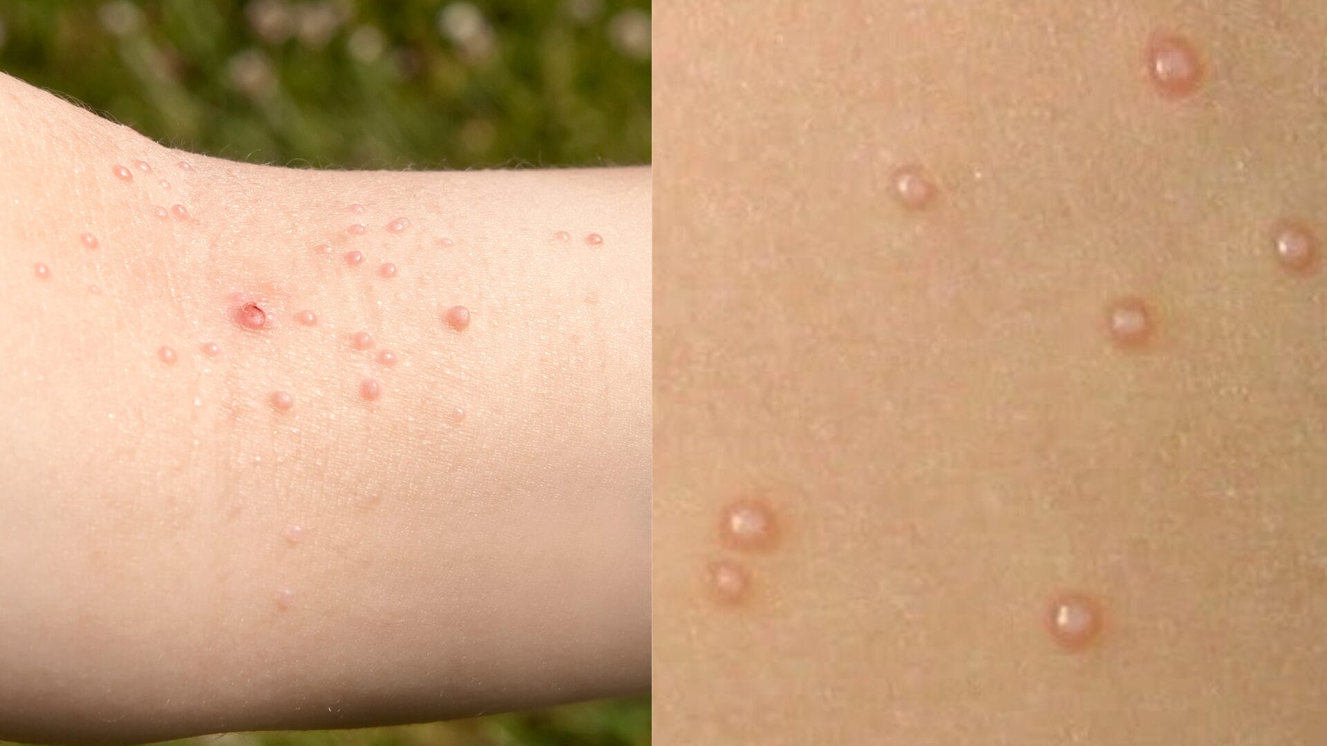 3 Natural Remedies for Treating Molluscum Contagiosum - Dr. Ana-Maria ...