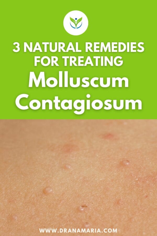 3 Natural Remedies for Treating Molluscum Contagiosum - Dr. Ana-Maria Temple